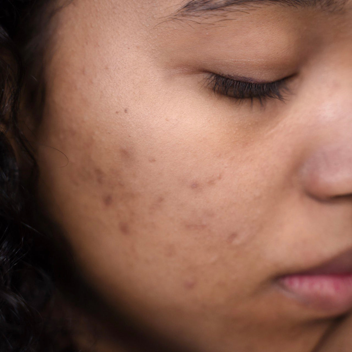 Breakouts this Summer? Here's How to Prevent Them – Sachi Skin